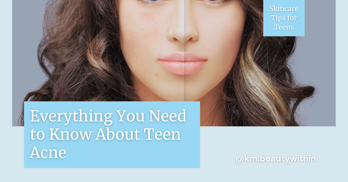 Everything You Need to Know About Teen Acne – Beauty Within Esthetics